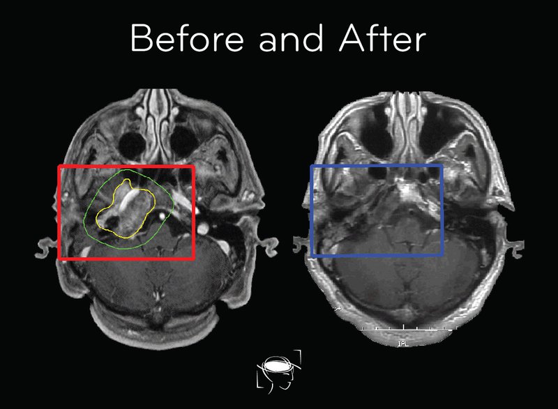 Brain Tumor Types, Glioblastoma, Meningioma & More