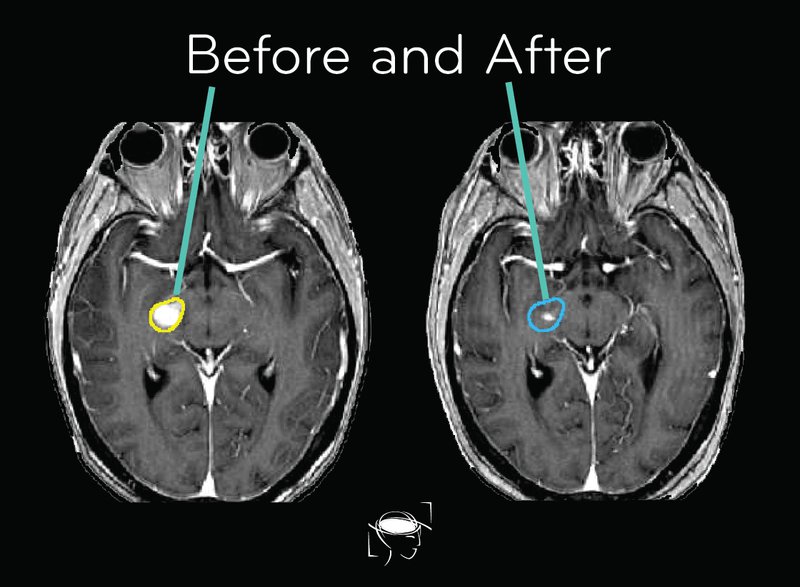 Brain Tumor Types, Glioblastoma, Meningioma & More
