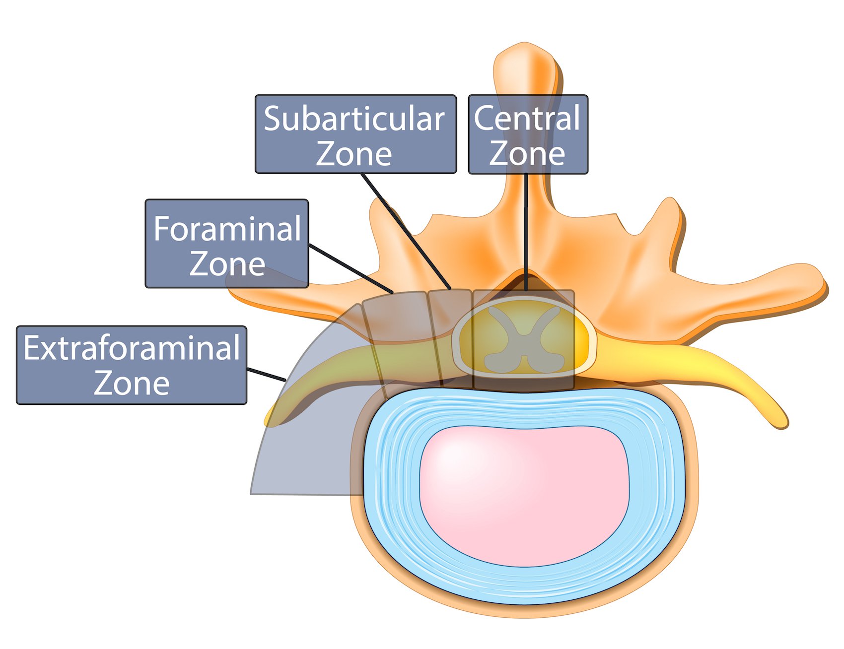 The Difference Between Bulging Disc And Herniated Disc 2022 